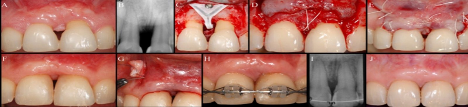 REGENERATION OF INTERPROXIMAL ATTACHMENT: CHALLENGE IN PERIODONTAL ...
