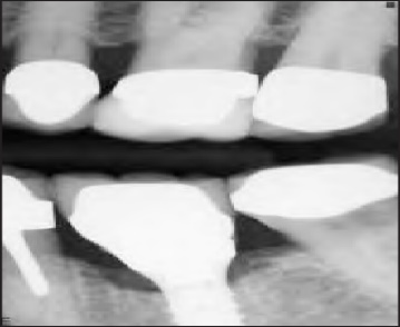 DIAGNOSTIC AND IMAGING TECHNIQUES IN IMPLANT DENTISTRY