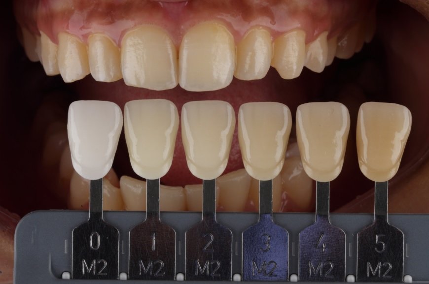SHADE SELECTION AND SHADE COMMUNICATION: PART-2