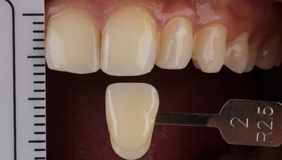 SHADE SELECTION AND SHADE COMMUNICATION: PART-2