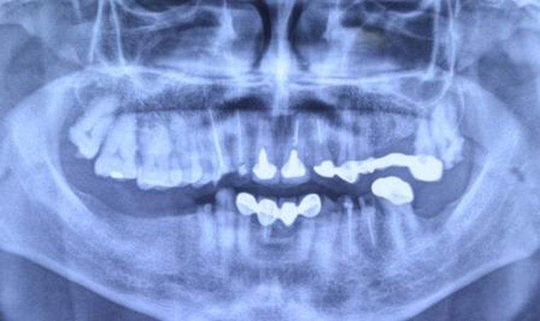 FULL MOUTH REHABILITATION OF SEVERELY ATTRITED TEETH: A CASE REPORT