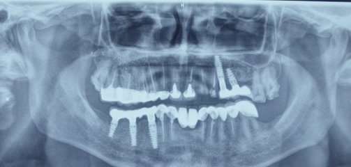 FULL MOUTH REHABILITATION OF SEVERELY ATTRITED TEETH: A CASE REPORT