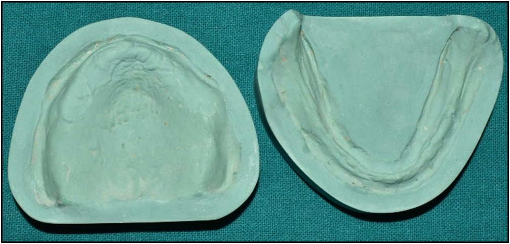 PROSTHODONTIC MANAGEMENT OF EDENTULOUS PATIENTS WITH FLABBY TISSUES: A ...