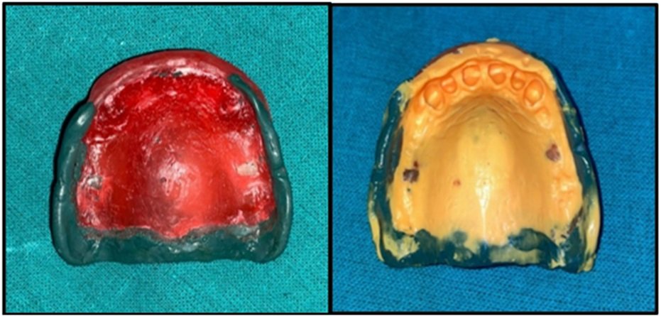 AN ACCUSTOMED BREAKTHROUGH: REHABILITATION OF BILATERALLY DISTAL ...