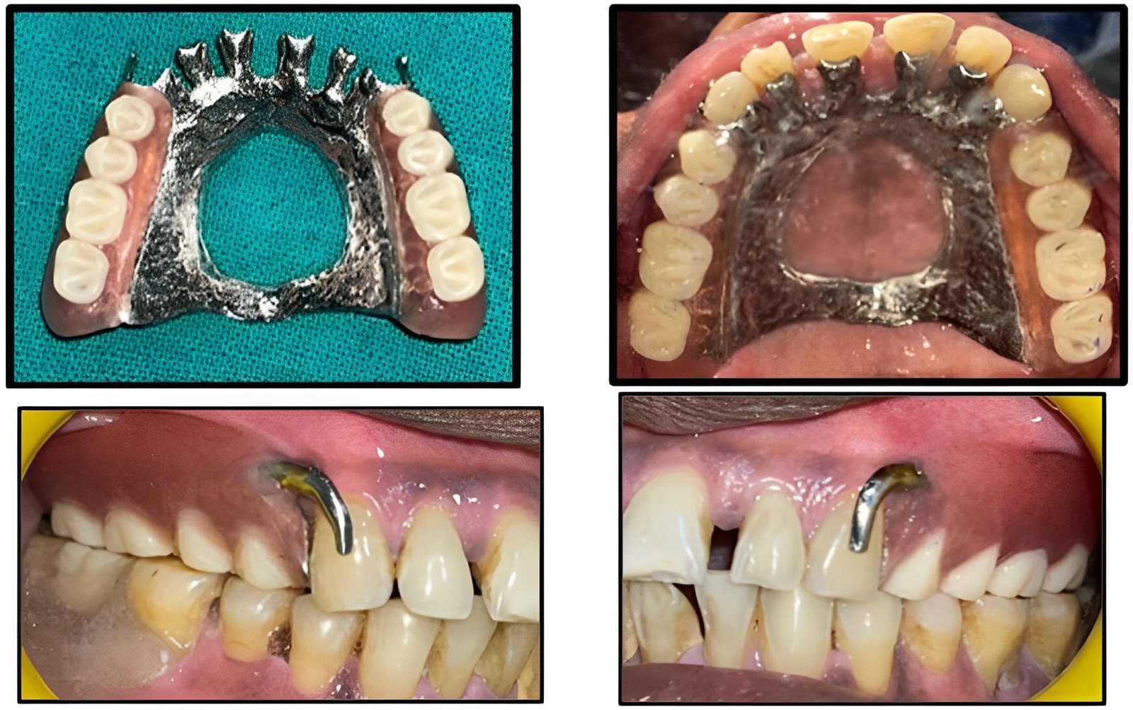AN ACCUSTOMED BREAKTHROUGH: REHABILITATION OF BILATERALLY DISTAL ...