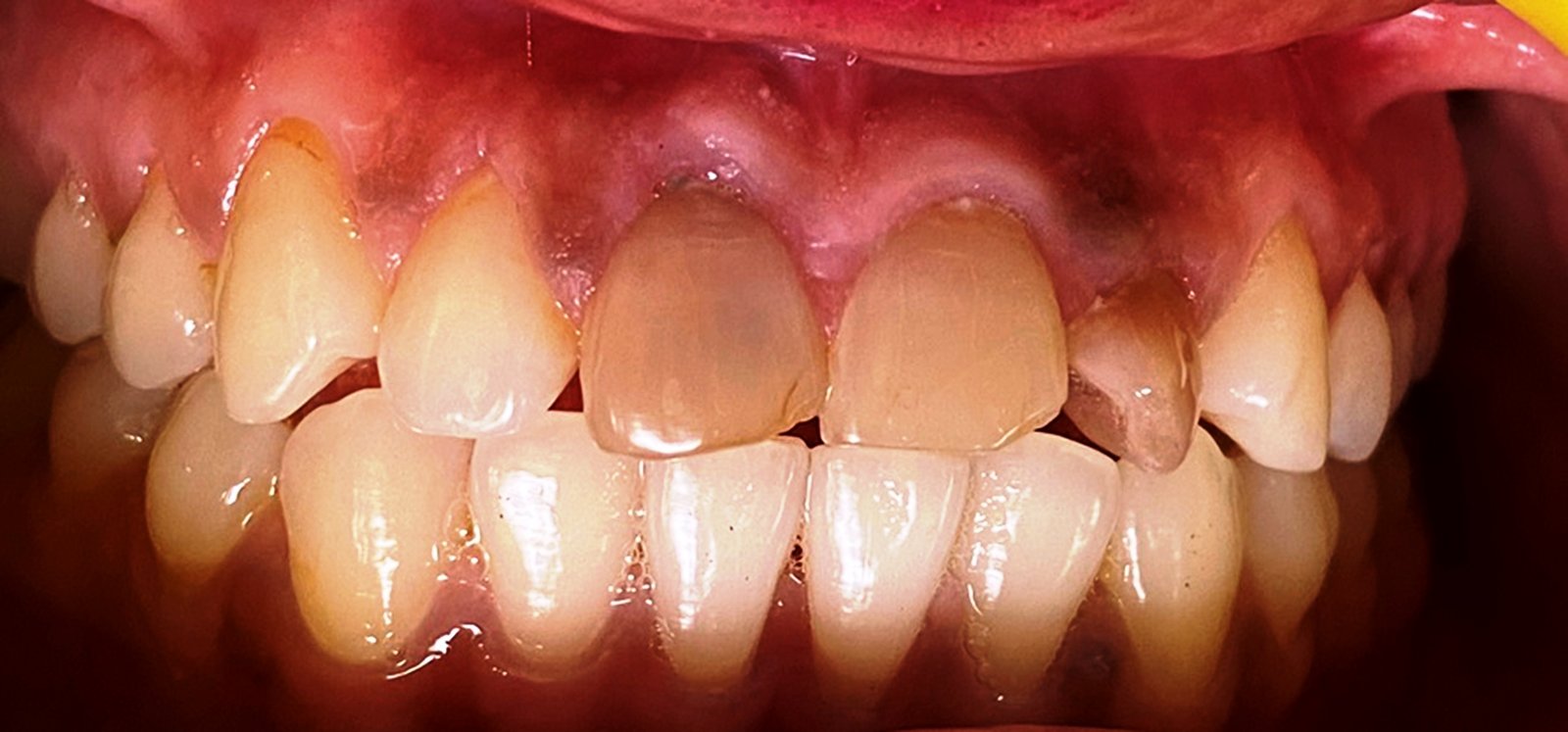 NON VITAL TOOTH BLEACHING: A CASE REPORT