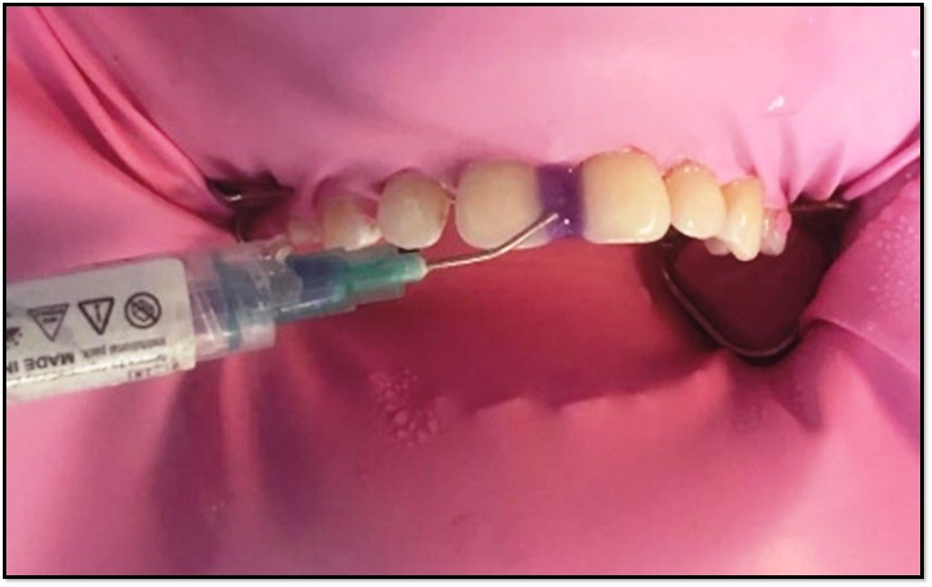 AESTHETIC MANAGEMENT OF MIDLINE DIASTEMA CLOSURE: A CASE REPORT