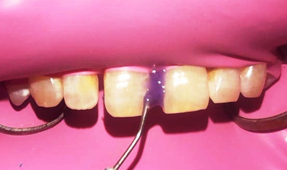 AESTHETIC MANAGEMENT OF MIDLINE DIASTEMA CLOSURE: A CASE REPORT