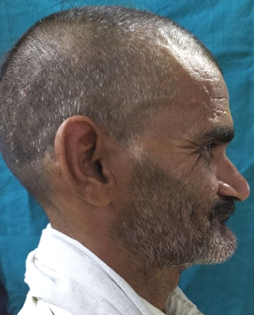 CRAFTING SMILES: THE ART OF PRECISION - COMPLETE DENTURE FABRICATION ...