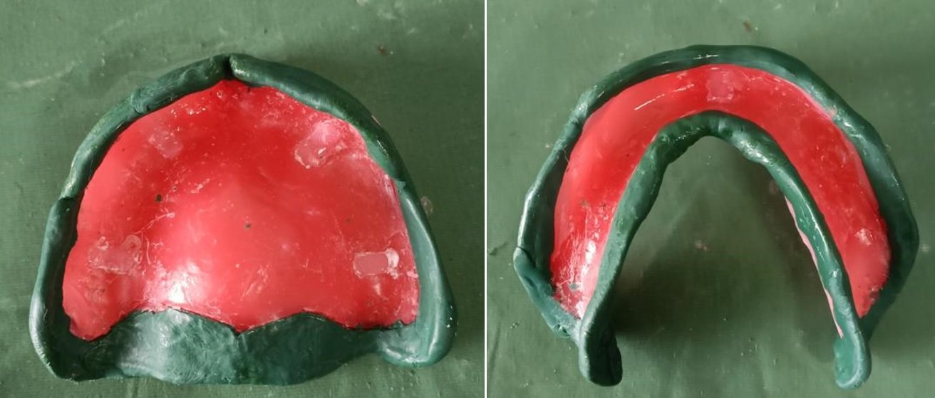 CRAFTING SMILES: THE ART OF PRECISION - COMPLETE DENTURE FABRICATION ...