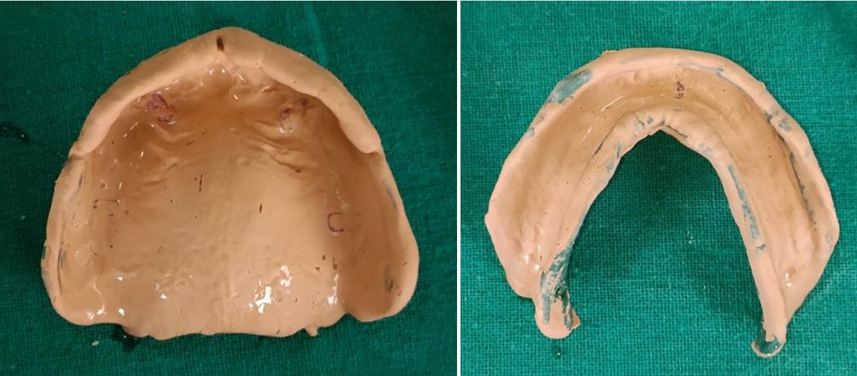 CRAFTING SMILES: THE ART OF PRECISION - COMPLETE DENTURE FABRICATION ...