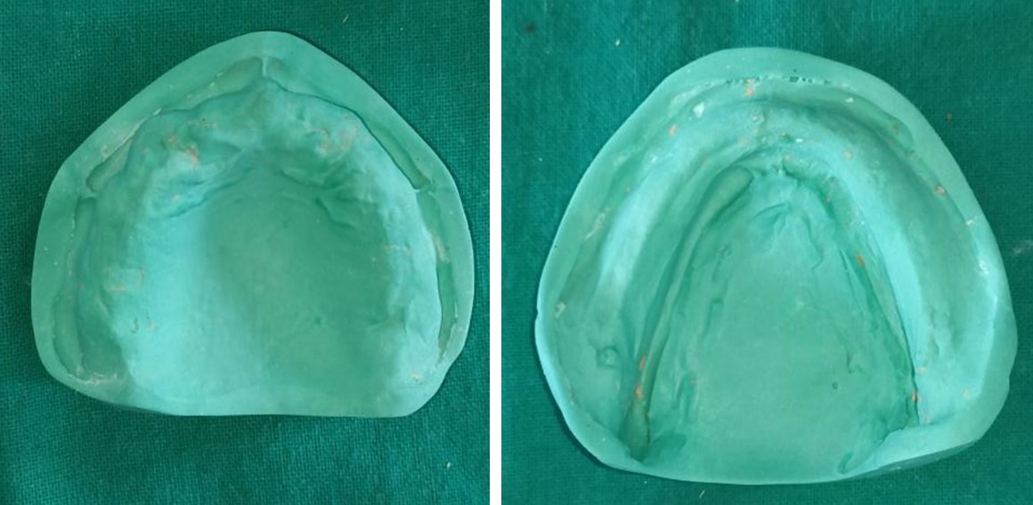 CRAFTING SMILES: THE ART OF PRECISION - COMPLETE DENTURE FABRICATION ...