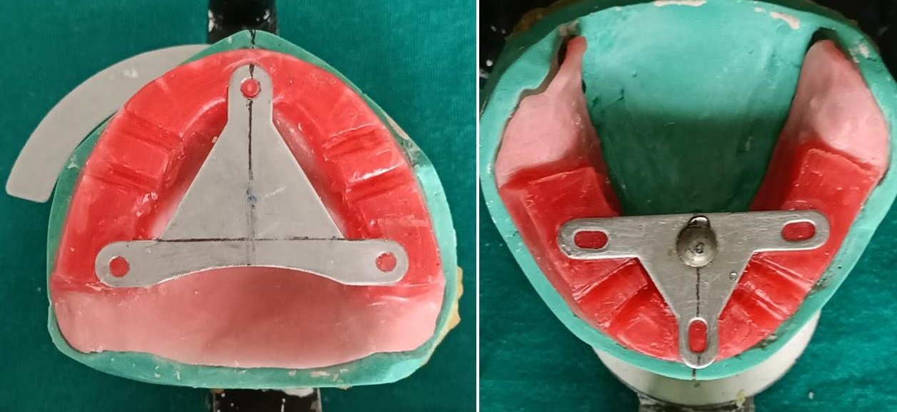 CRAFTING SMILES: THE ART OF PRECISION - COMPLETE DENTURE FABRICATION ...