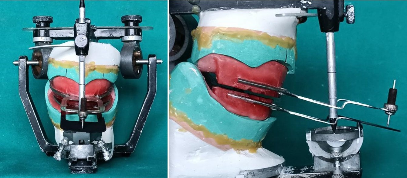 CRAFTING SMILES: THE ART OF PRECISION - COMPLETE DENTURE FABRICATION ...