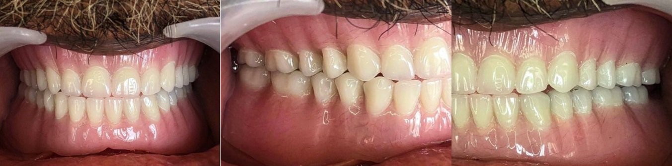 CRAFTING SMILES: THE ART OF PRECISION - COMPLETE DENTURE FABRICATION ...