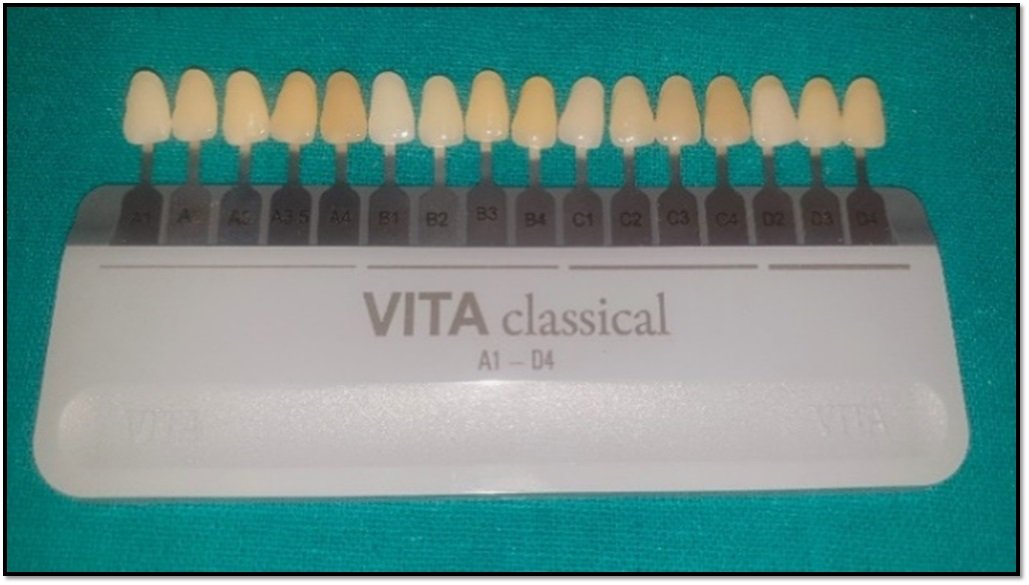 SMILE RENEWAL: PRECISION AND BEAUTY UNVEILED WITH CAD-CAM DENTAL TECHNOLOGY
