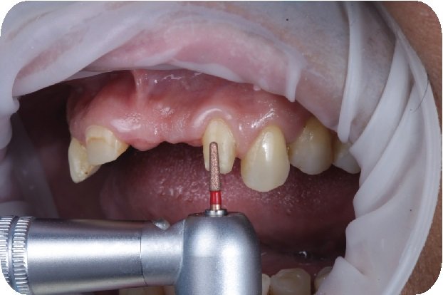 ISOLATION IN CLINICAL DENTISTRY: PART-2