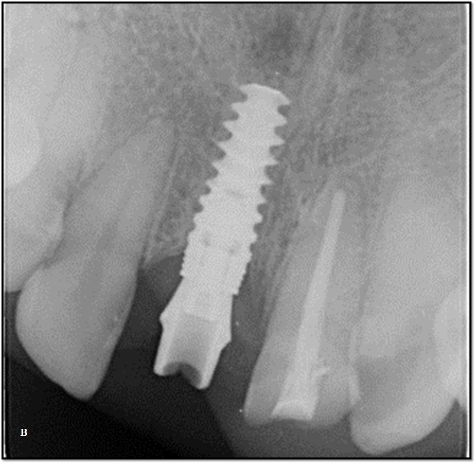 IMMEDIATE TEMPORIZATION IN THE AESTHETIC ZONE USING NOBLE ACTIVE TI ...