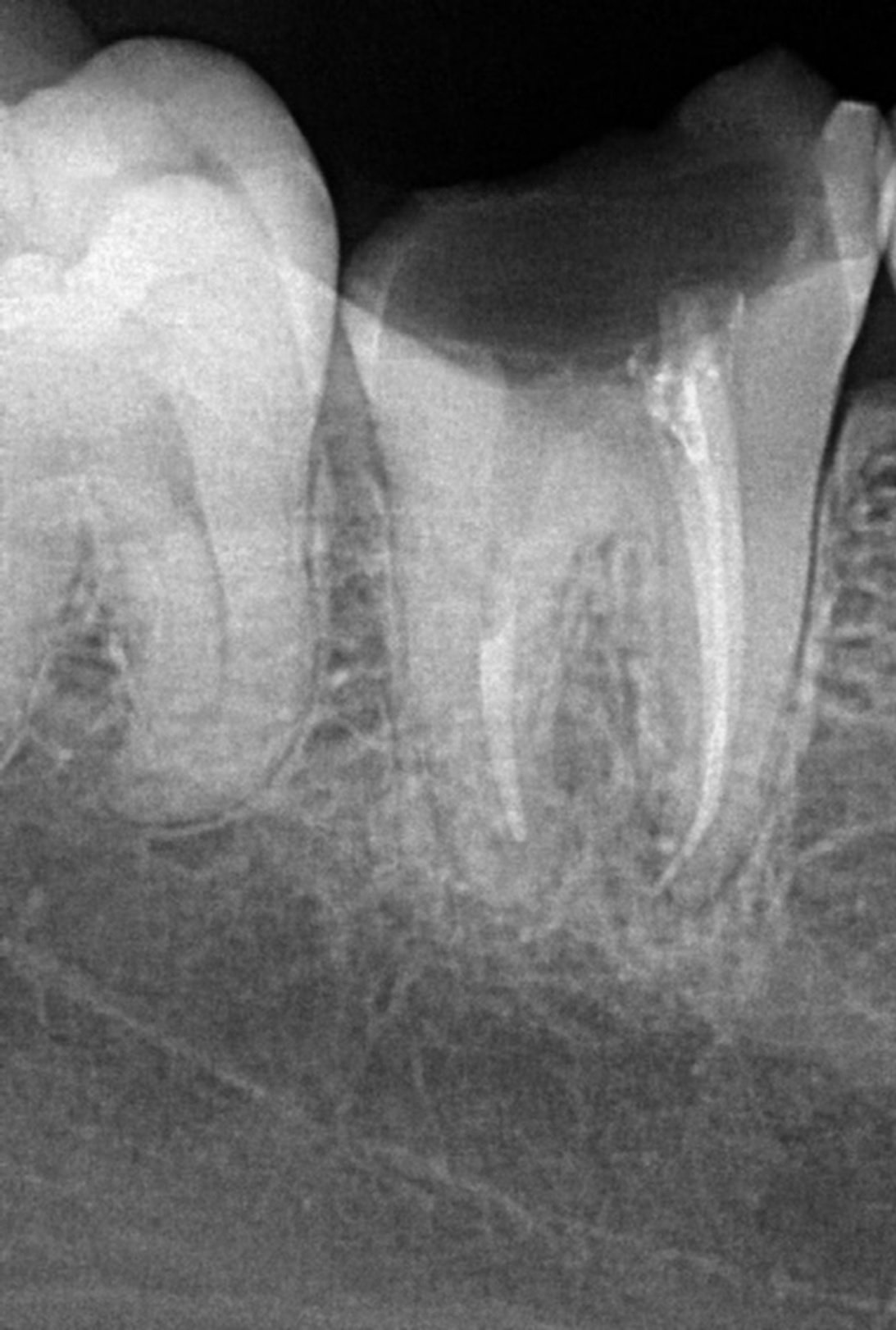 DIRECT APPLICATION OF FIBER-REINFORCED COMPOSITE RESINS IN POST ...