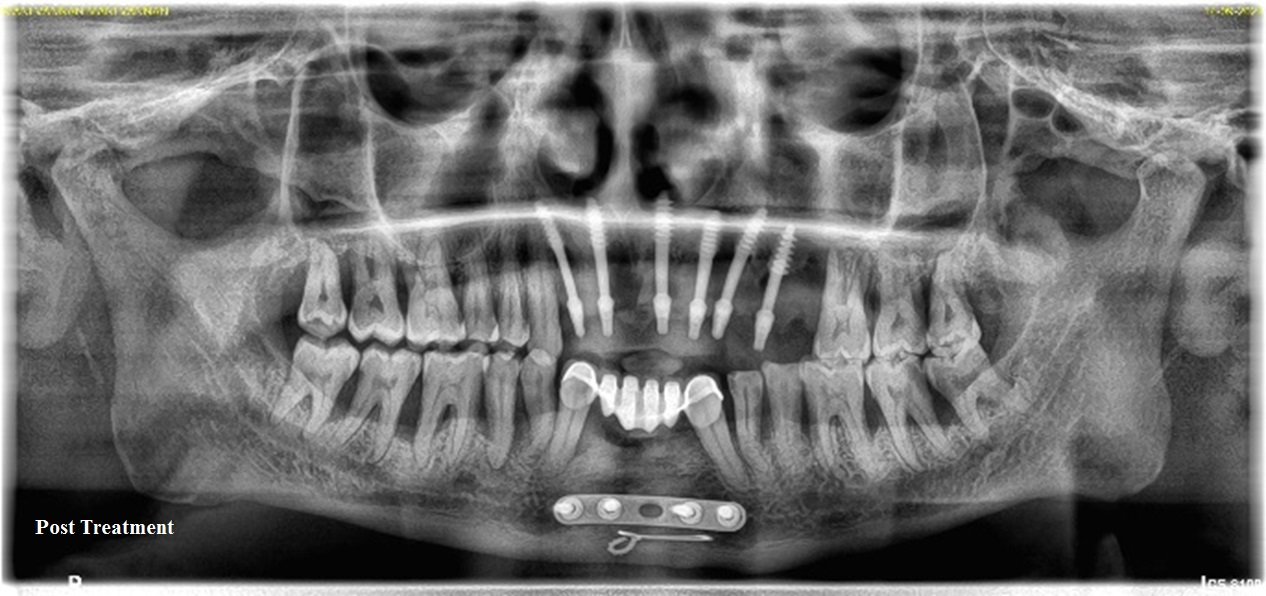 CORTICO BASAL IMPLANTOLOGY-TODAY: A CASE REPORT